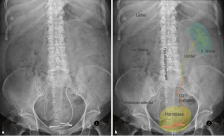 Fremdmaterialien im Urogenitaltrakt | SpringerLink