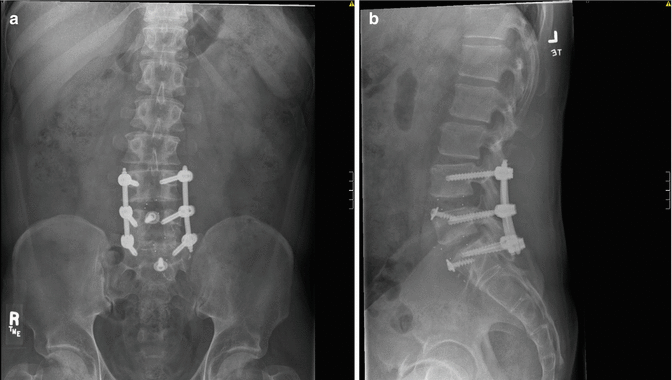Anterior Lumbar Interbody Fusion (ALIF) | SpringerLink