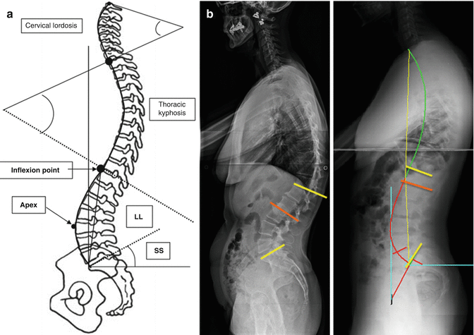 The Importance of Sagittal Balance for the Treatment of Lumbar ...