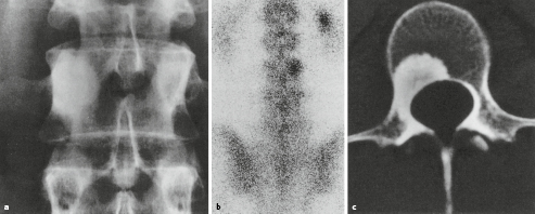 Primäre und sekundäre Knochengeschwülste | SpringerLink