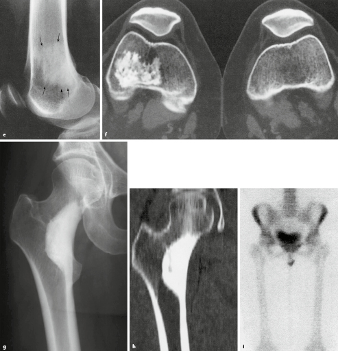 Primäre und sekundäre Knochengeschwülste | SpringerLink