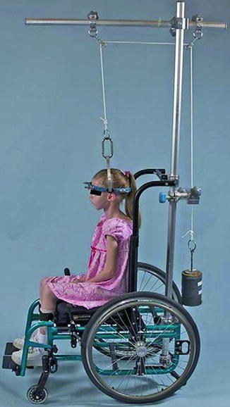 Halo-Gravity Traction | SpringerLink