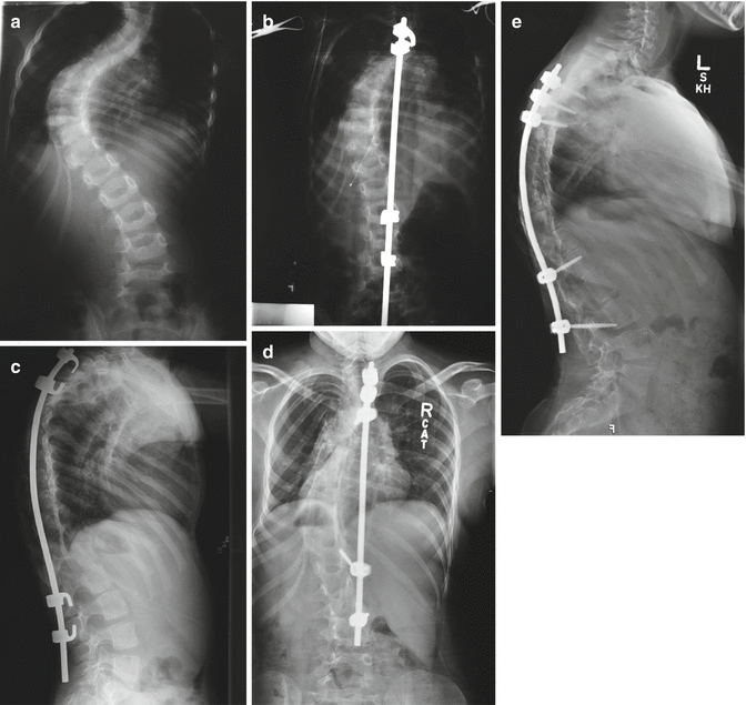 Single and Dual Traditional Growing Rods | SpringerLink