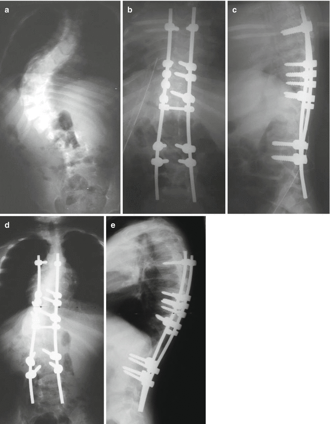 Growth-Guided Instrumentation: Shilla Procedure | SpringerLink