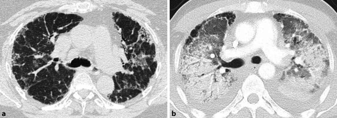 Idiopathische Lungenfibrose | SpringerLink
