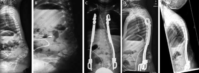 Neuromuskuläre Skoliose | SpringerLink
