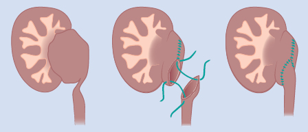 Harntransportstörungen und Harnwegsinfektionen | SpringerLink