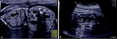 Harntransportstörungen und Harnwegsinfektionen | SpringerLink