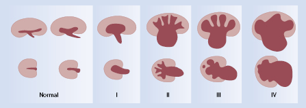 Harntransportstörungen und Harnwegsinfektionen | SpringerLink