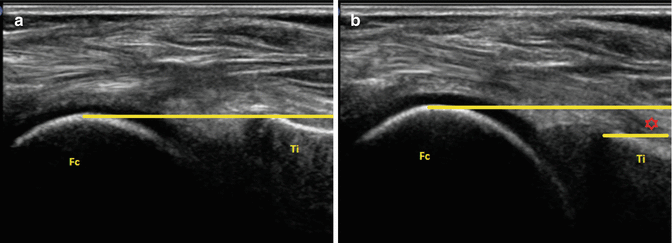 Meniscus Ultrasound | SpringerLink