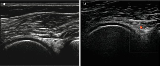 Meniscus Ultrasound | SpringerLink