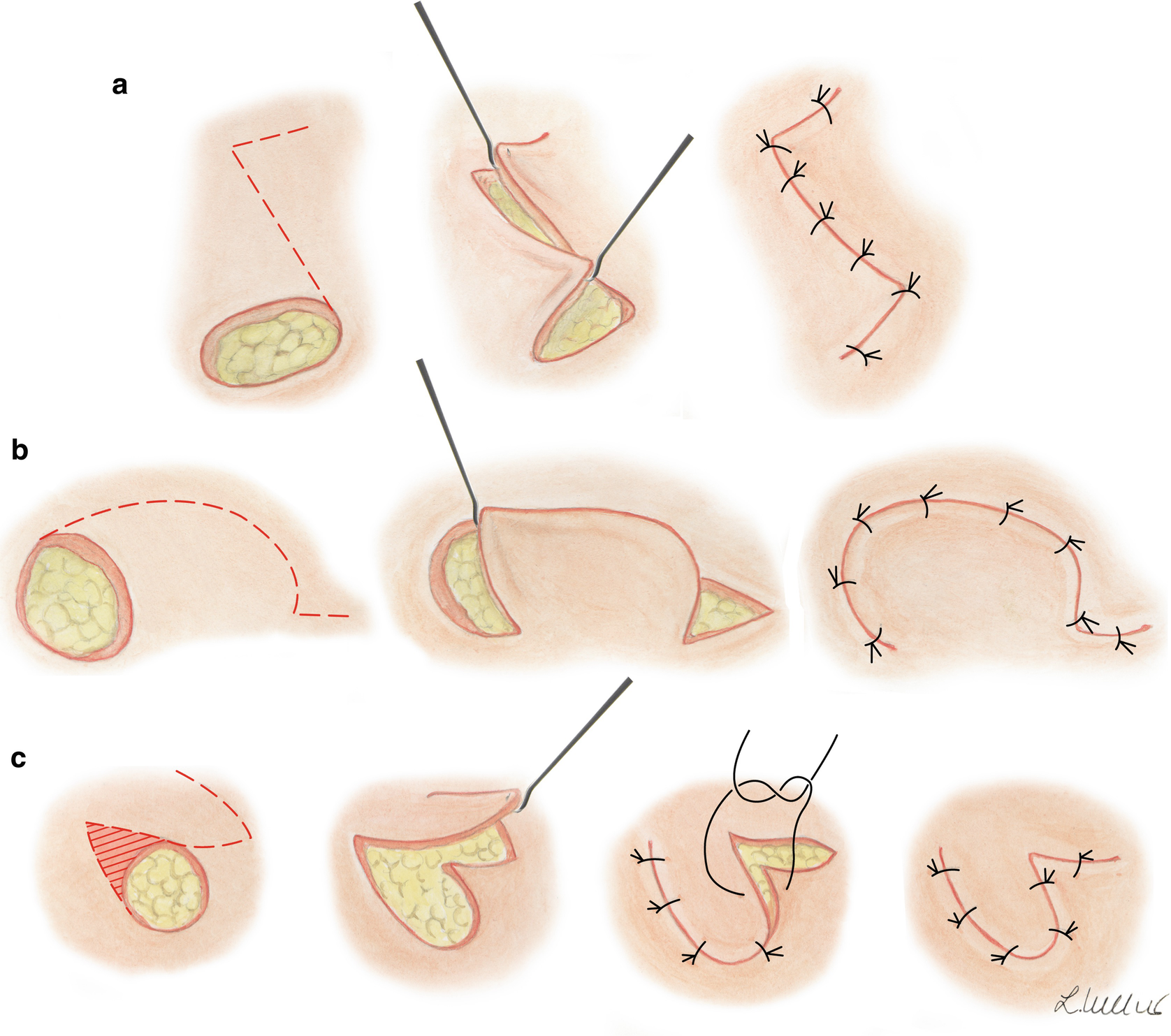 Operative Dermatologie | SpringerLink
