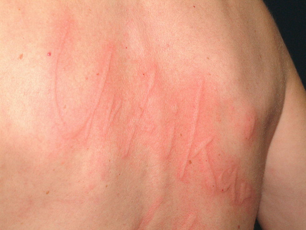 Urtikaria und Angioödem | SpringerLink