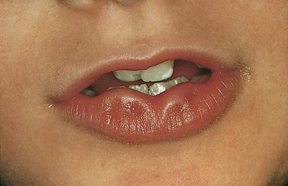 Erkrankungen der Lippen und der Mundhöhle | SpringerLink