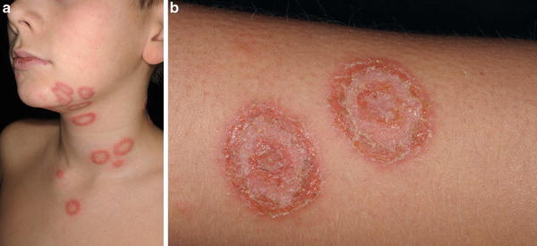 Mykosen | SpringerLink