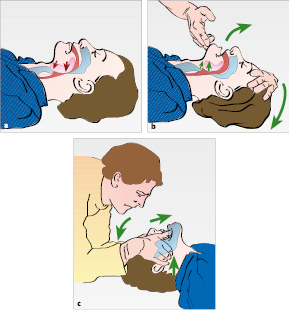 Atemwegssicherung, Intubation und Beatmung | SpringerLink