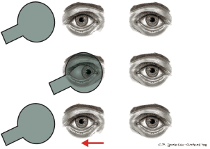 Strabismus | SpringerLink