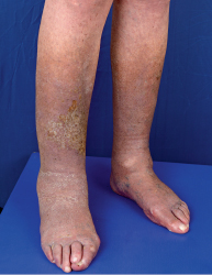 Gefäßerkrankungen und Durchblutungsstörungen | SpringerLink