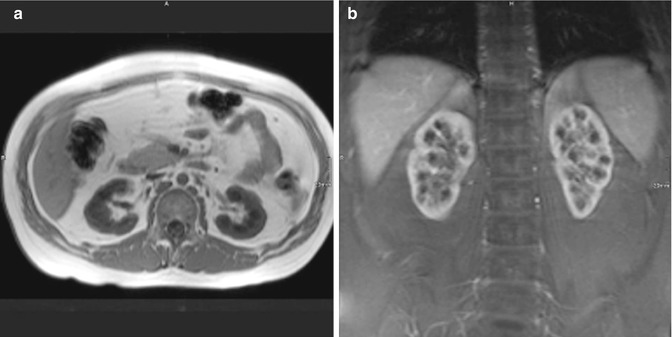 Nephronophthisis and Autosomal Dominant Interstitial Kidney Disease ...