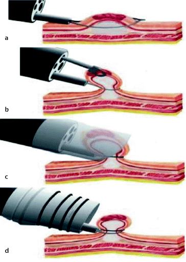 Endoskopische Mukosaresektion und Submukosadissektion | SpringerLink