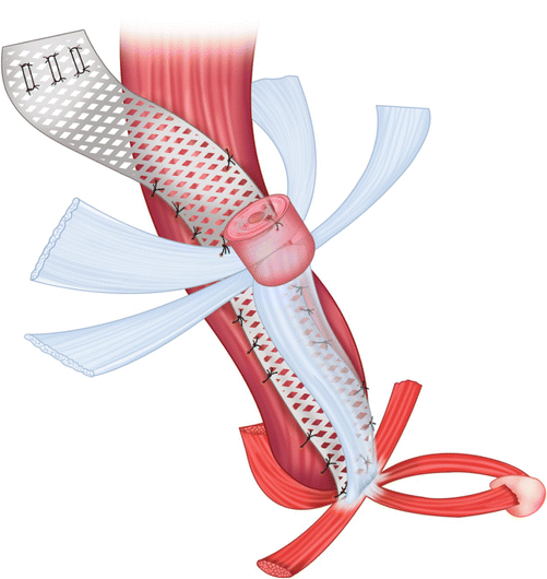 Rectal Prolapse, Intussusception, Solitary Rectal Ulcer | SpringerLink