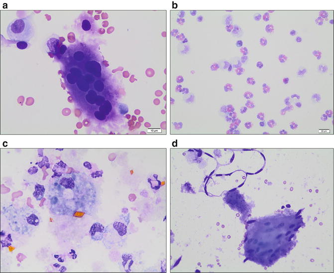 CSF and CNS Cytology | SpringerLink