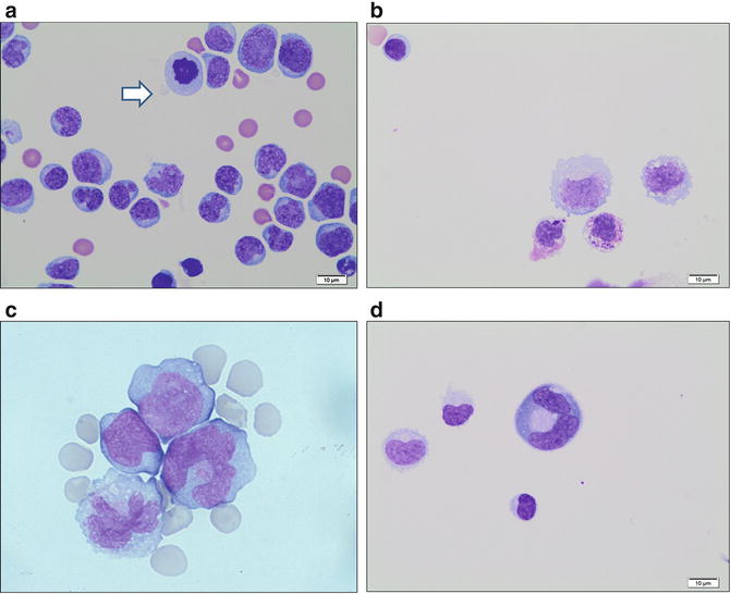CSF and CNS Cytology | SpringerLink