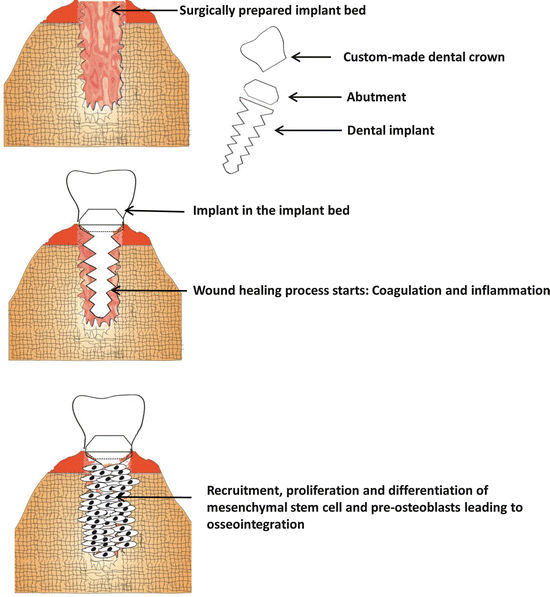 Implant Surface Modifications and Osseointegration | SpringerLink
