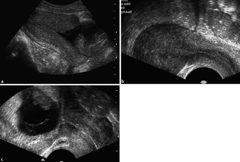 Intrapartaler Ultraschall | SpringerLink
