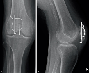 Allgemeine Osteosyntheseverfahren | SpringerLink