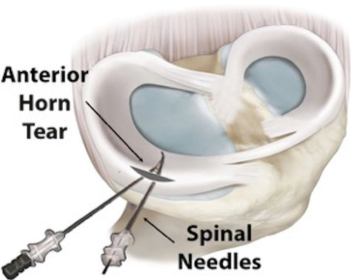 Outside-in Meniscal Repair: Technique and Outcomes | SpringerLink