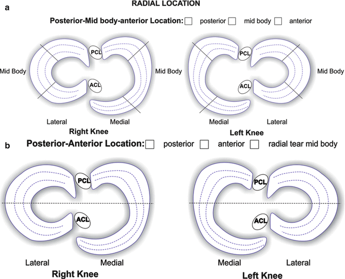 Classification of Meniscal Tears | SpringerLink