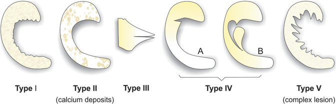 Classification of Meniscal Tears | SpringerLink