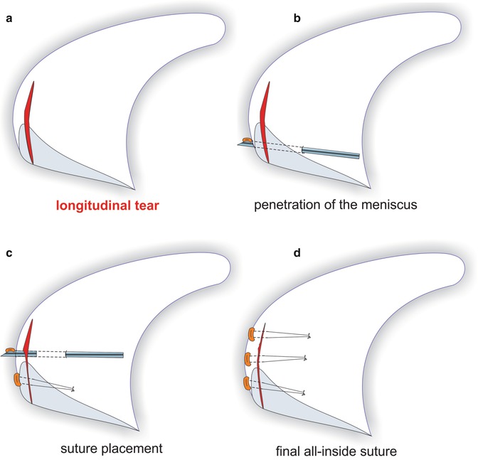 All-Inside Meniscal Repair: Updates on Technique | SpringerLink