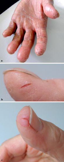 Haut- und Nagelveränderungen | SpringerLink