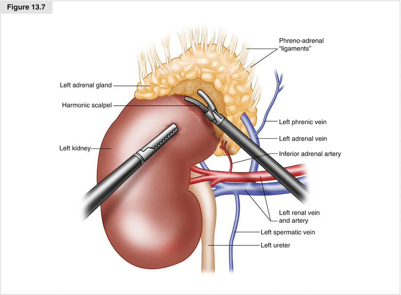 Posterior Retroperitoneoscopic Adrenalectomy | SpringerLink