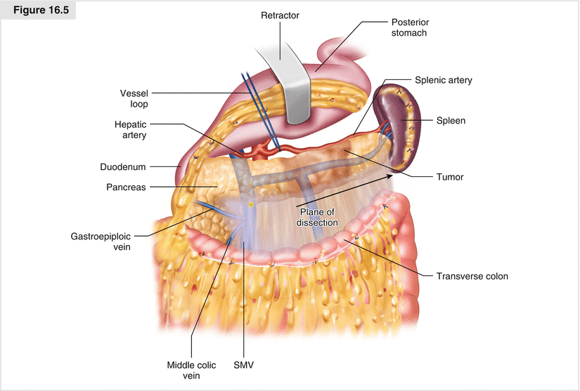 Open Distal Pancreatectomy | SpringerLink