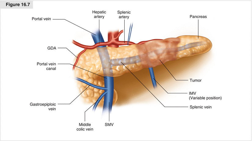 Open Distal Pancreatectomy | SpringerLink