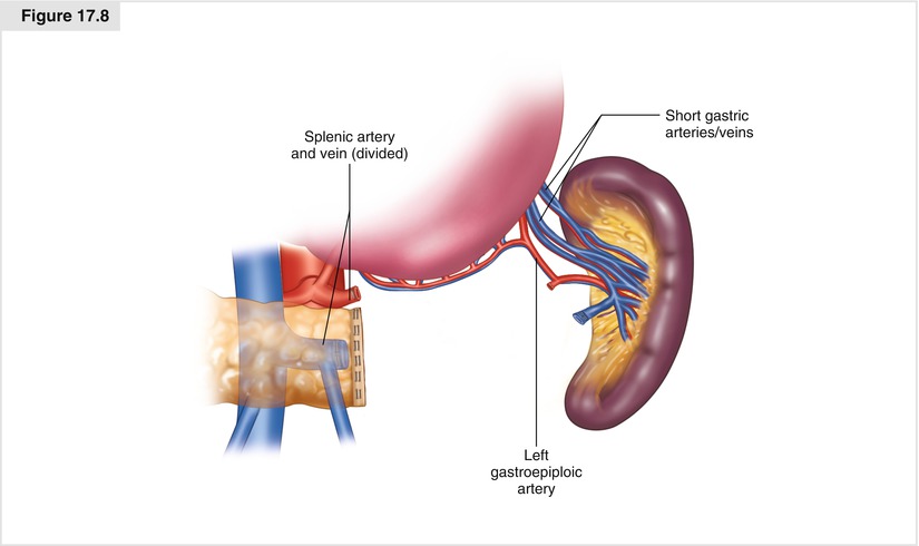 Laparoscopic Distal Pancreatectomy | SpringerLink