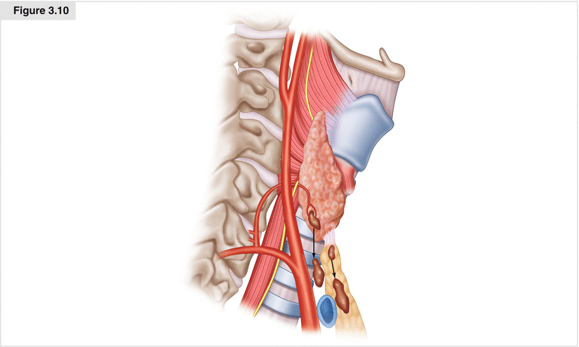 Subtotal Parathyroidectomy for Parathyroid Hyperplasia | SpringerLink