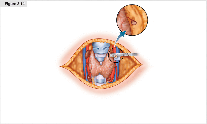Subtotal Parathyroidectomy for Parathyroid Hyperplasia | SpringerLink