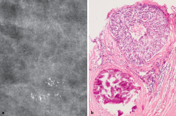 Pathologie der Mamma | SpringerLink