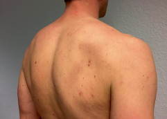 Nervus-suprascapularis-Kompressionssyndrom – arthroskopisches Release ...