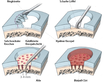 Chondrale und osteochondrale Läsionen | SpringerLink