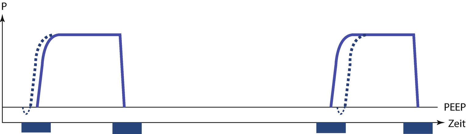 BIPAP (Biphasic Positive Airway Pressure/BiLevel/DuoPAP/BiVent ...