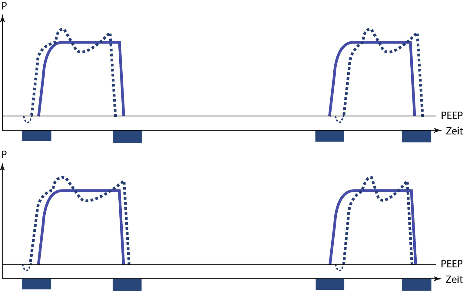 BIPAP (Biphasic Positive Airway Pressure/BiLevel/DuoPAP/BiVent ...