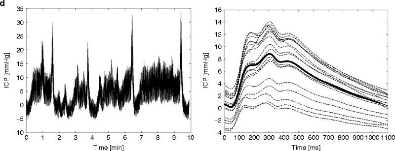 Association Between ICP Pulse Waveform Morphology and ICP B Waves ...