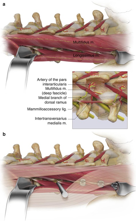 Minimally Invasive Wiltse Approaches for Posterolateral Fusion ...