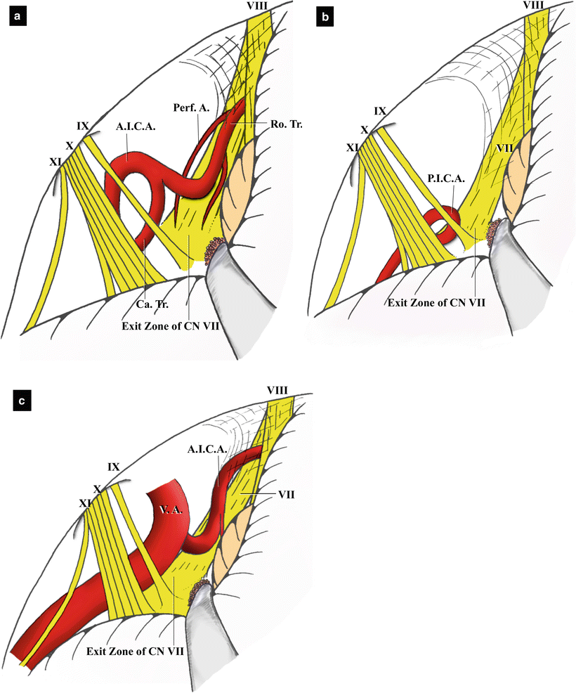 Microvascular Decompression Surgery for Hemifacial Spasm: The Lateral ...