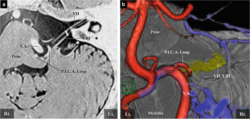 Microvascular Decompression Surgery for Hemifacial Spasm: The Lateral ...